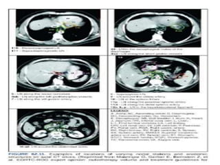 Radiotherapy in carcinoma stomach - current scenario | PPTX