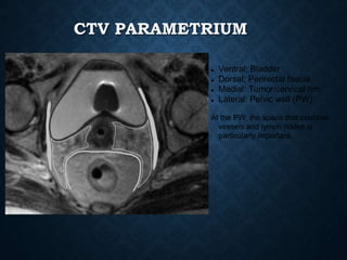 Radiotherapy in Cervical Cancers1.ppt