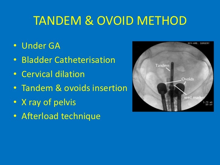 Radiotherapy of cervical cancer