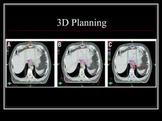 Radiotherapy Planning For Esophageal Cancers | PPT