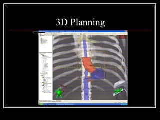 Radiotherapy Planning For Esophageal Cancers | PPT
