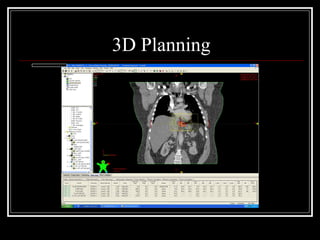 Radiotherapy Planning For Esophageal Cancers | PPT