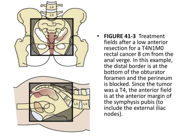 Radiotherapy planning for rectal cancer ,2D updates! | PPTX | Cancer ...