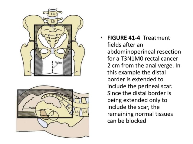 Radiotherapy planning for rectal cancer ,2D updates! | PPTX | Cancer ...