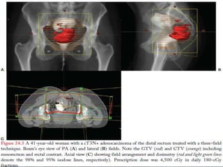 Radiotherapy planning for rectal cancer ,2D updates! | PPTX