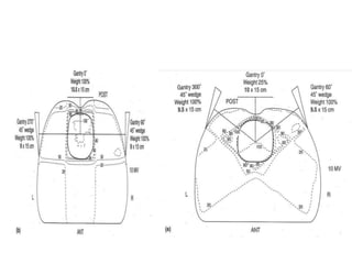 Radiotherapy planning for rectal cancer ,2D updates! | PPTX