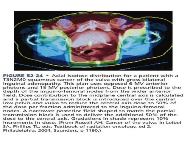 Radiotherapy planning for vulvar cancer September 2020 | PPTX
