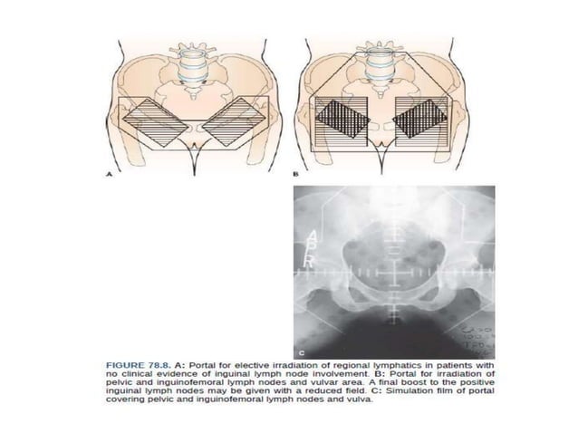 Radiotherapy planning for vulvar cancer September 2020 | PPTX