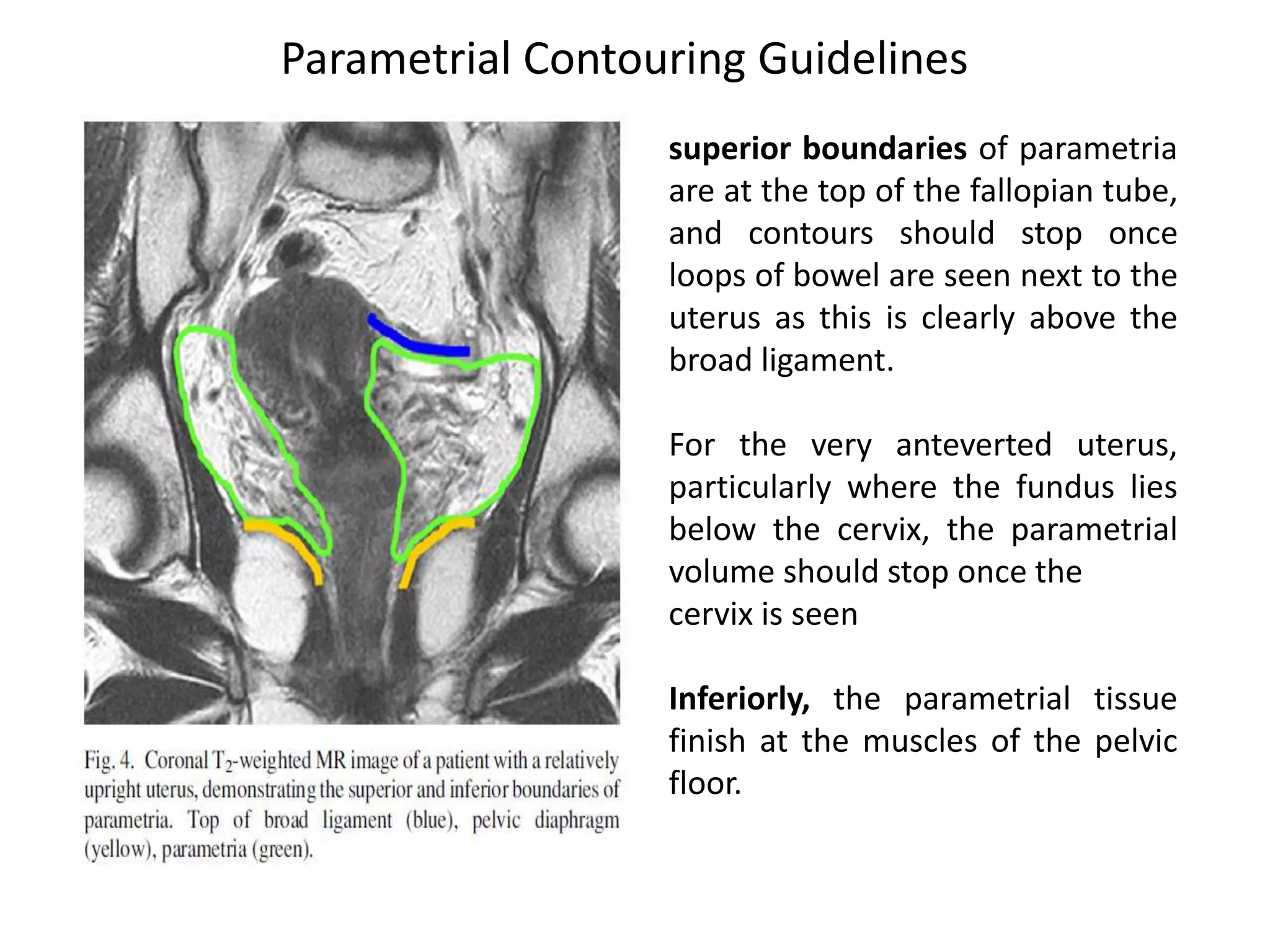 Radiotherapy planning in carcinoma cervix dr rekha | PPTX