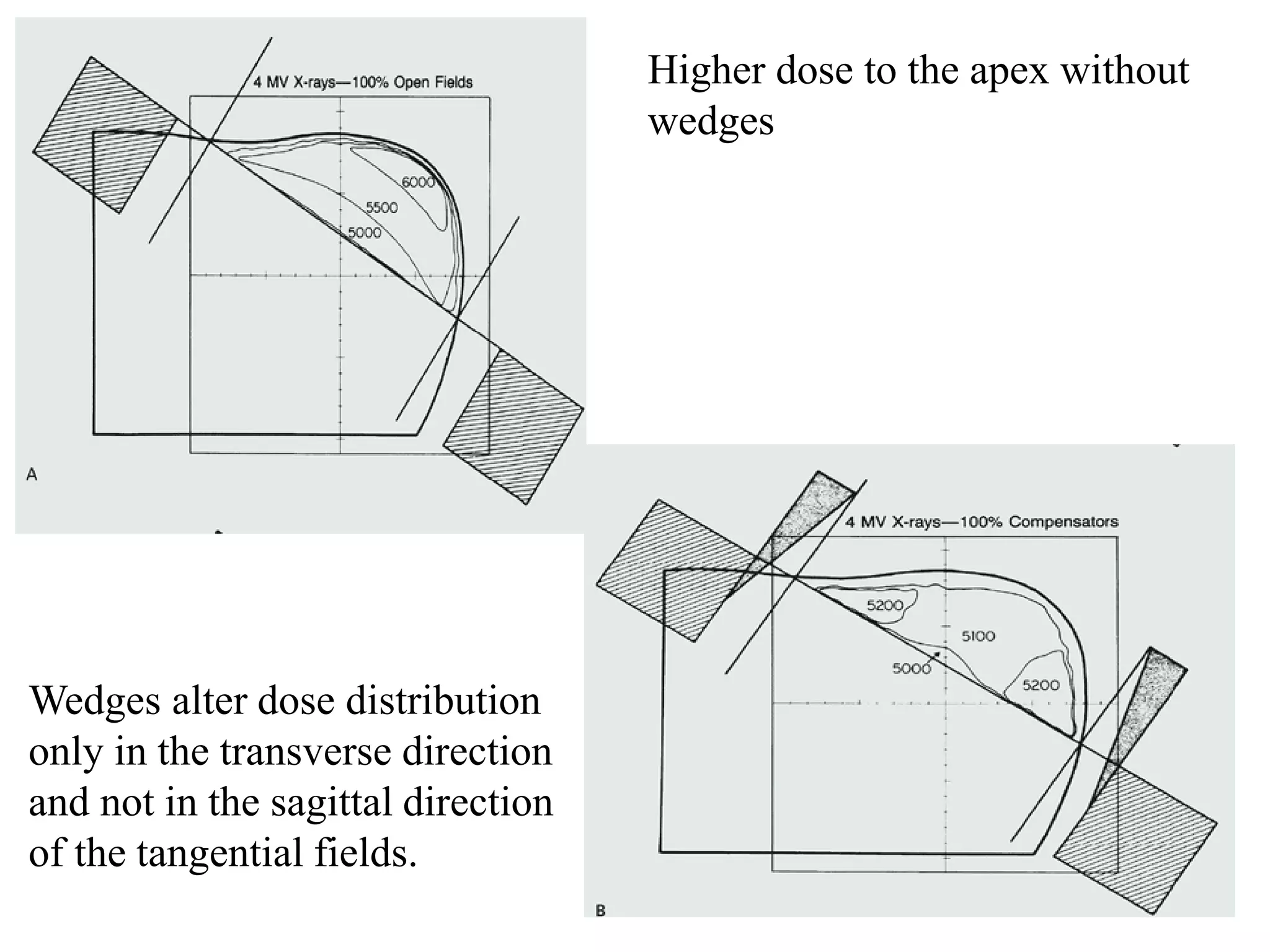 Radiotherapy techniques for Breast Cancer | PDF