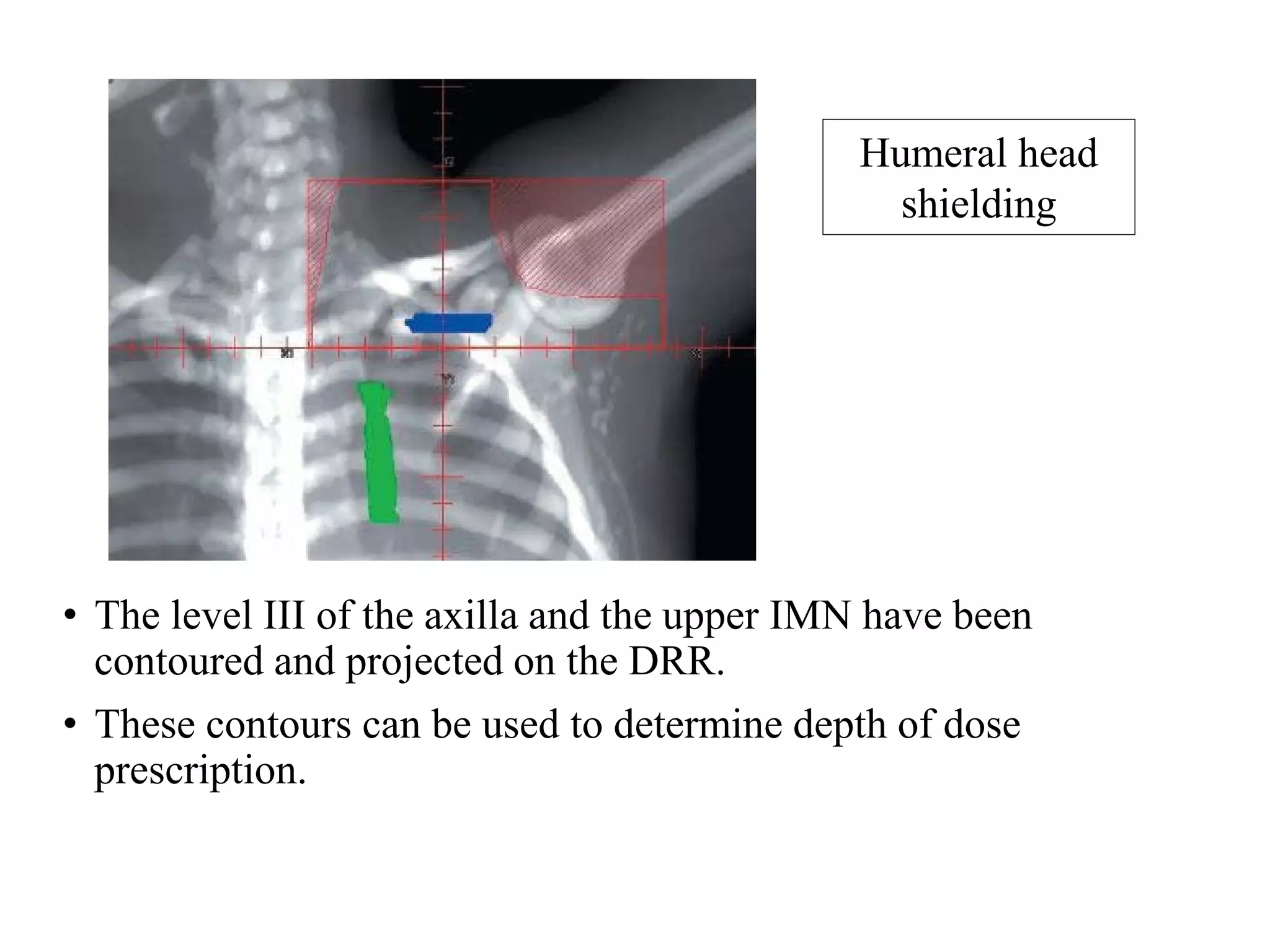 Radiotherapy techniques for Breast Cancer | PDF