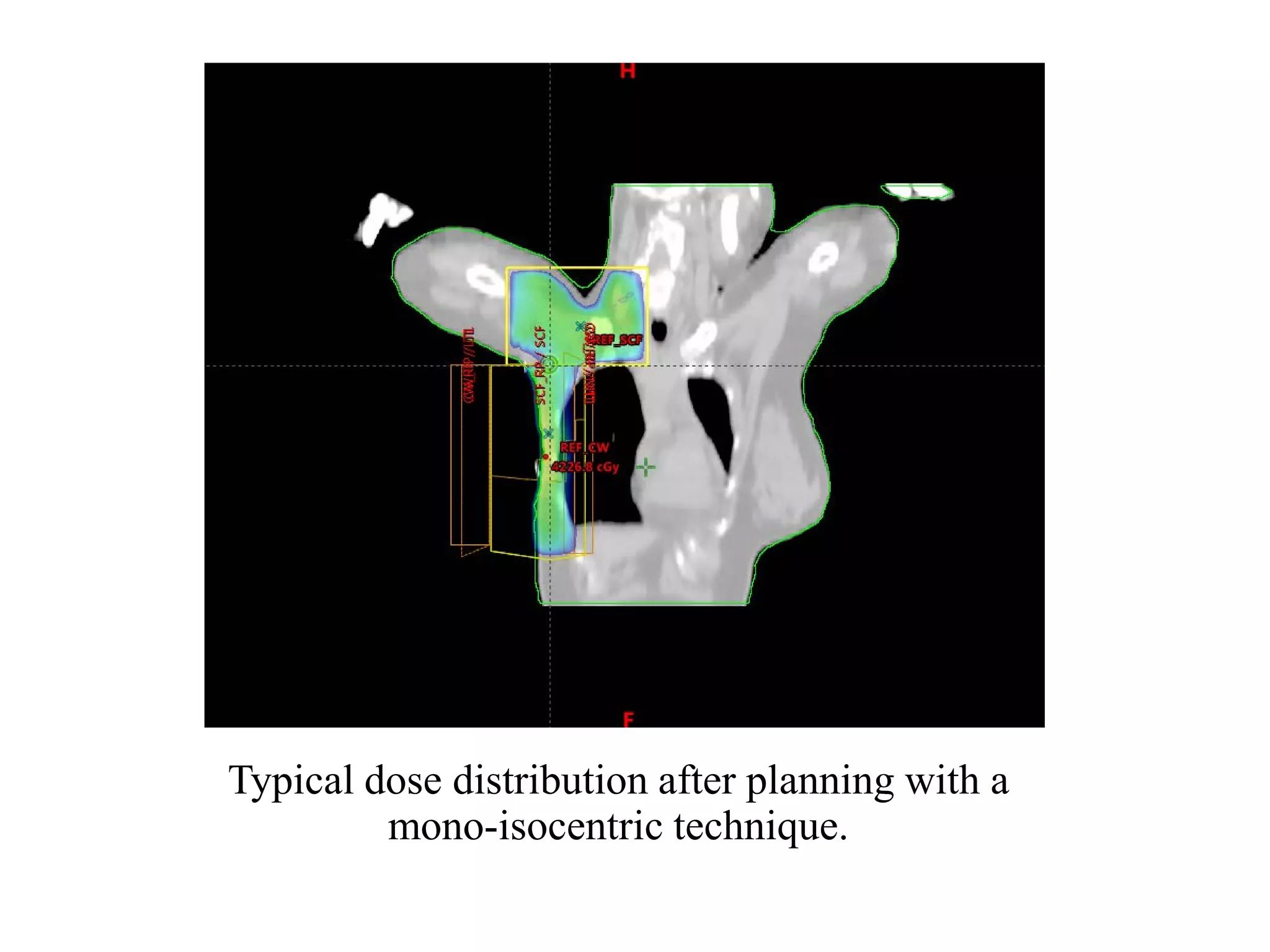 Radiotherapy techniques for Breast Cancer | PDF