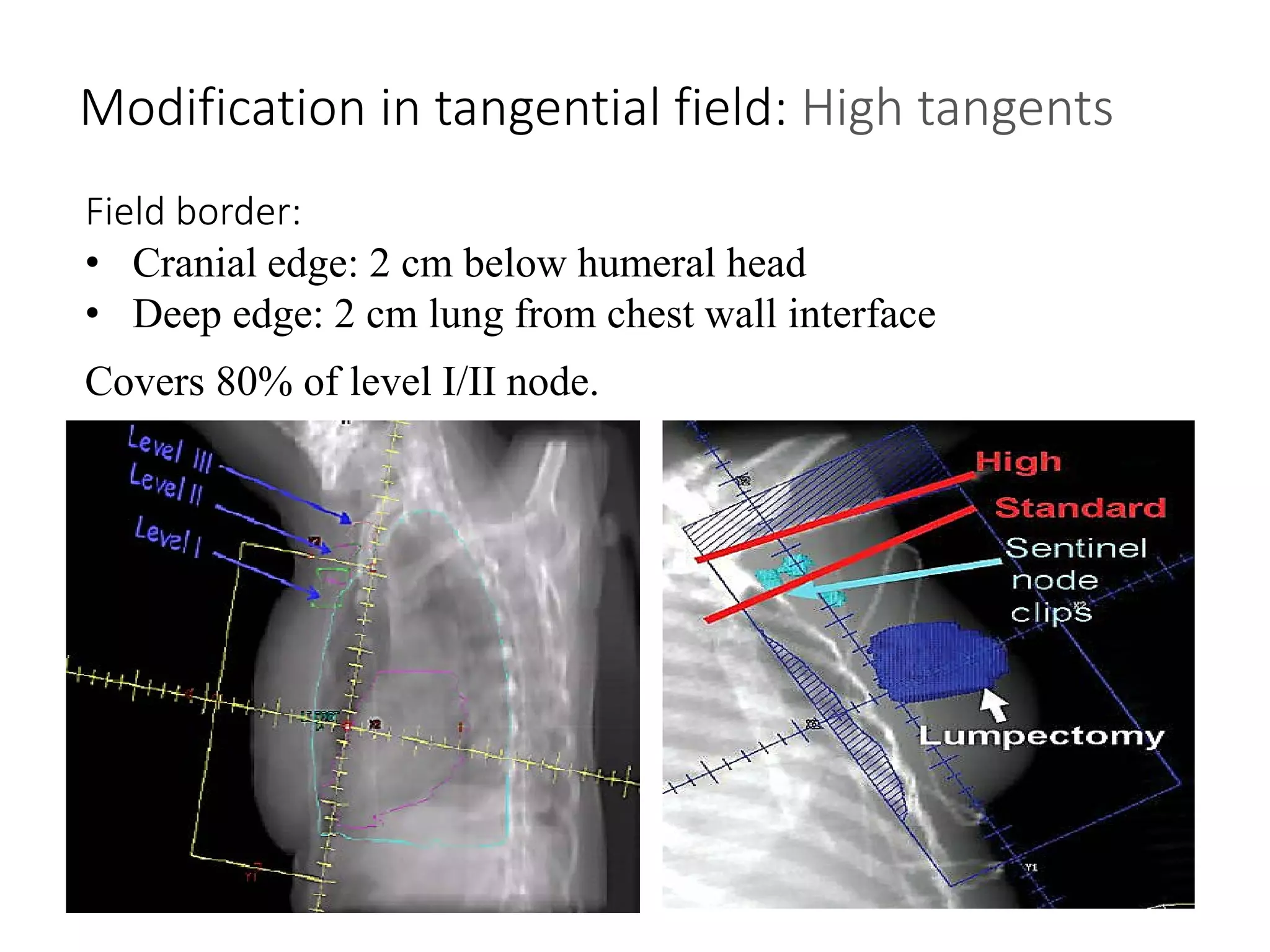 Radiotherapy techniques for Breast Cancer | PDF