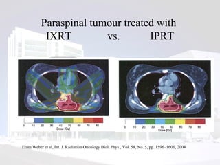 Radiotherapy With Protons | PPT