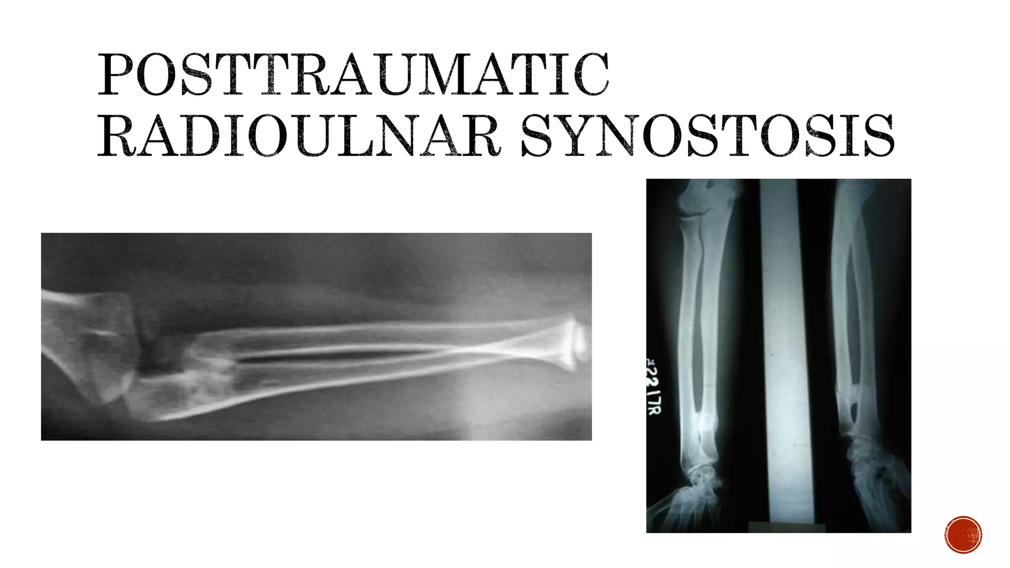 Radioulnar synostosis | PPTX