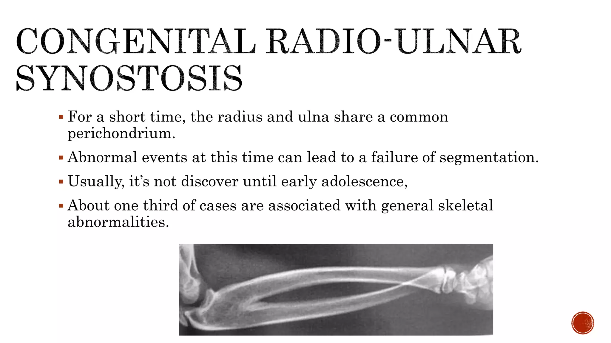 Radioulnar synostosis | PPTX