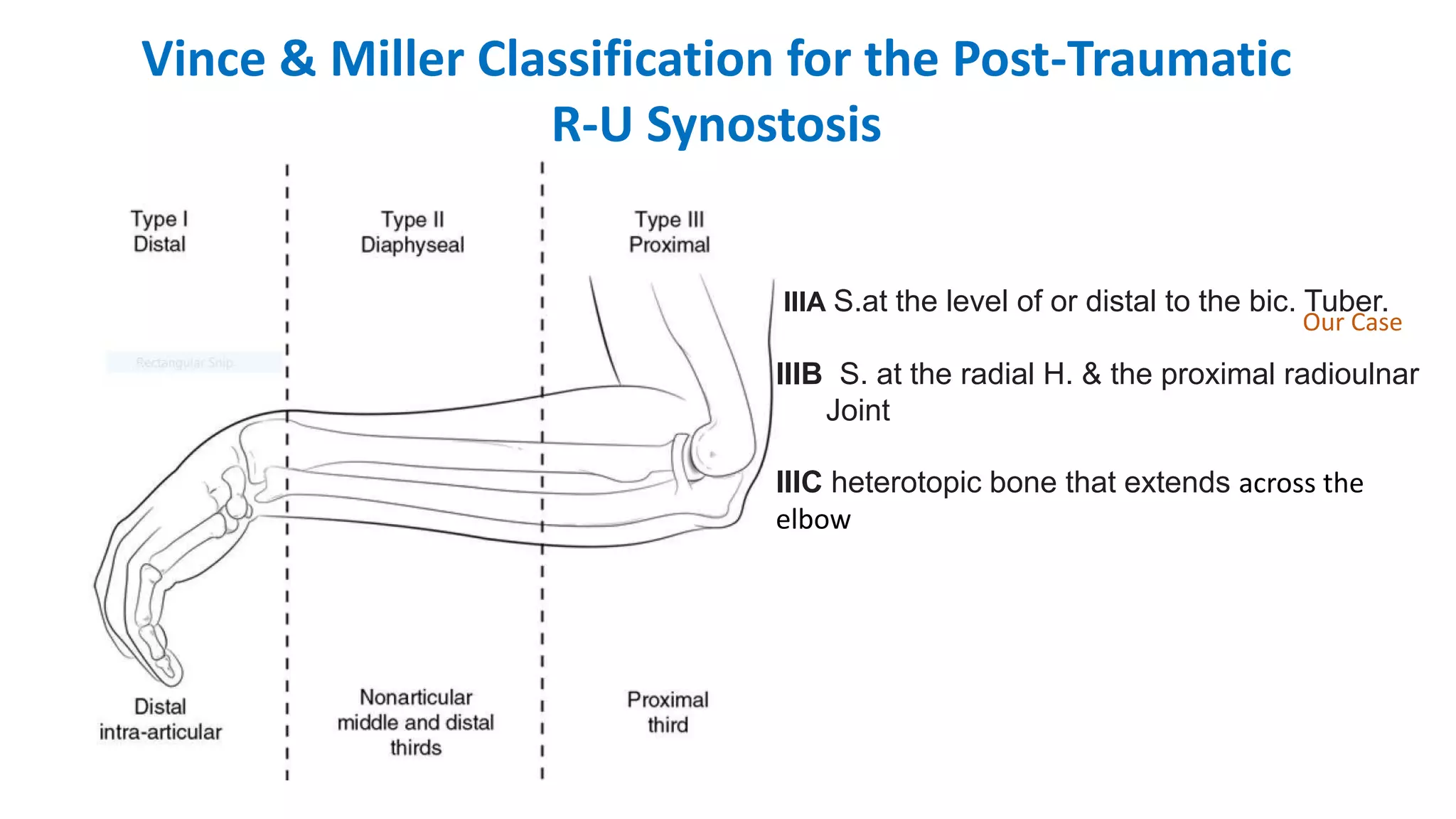 Radio ulnar synostosis #dr_azanki | PPTX
