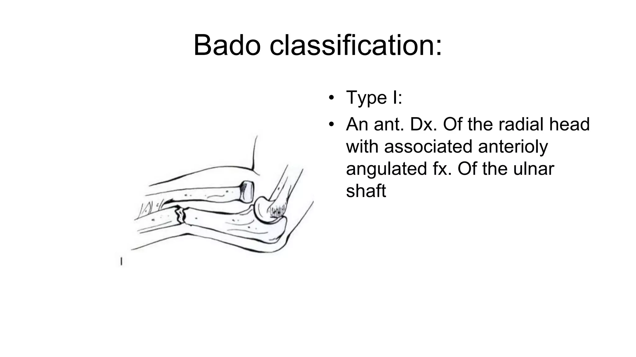 Radius and ulnar shaft fx | PPTX