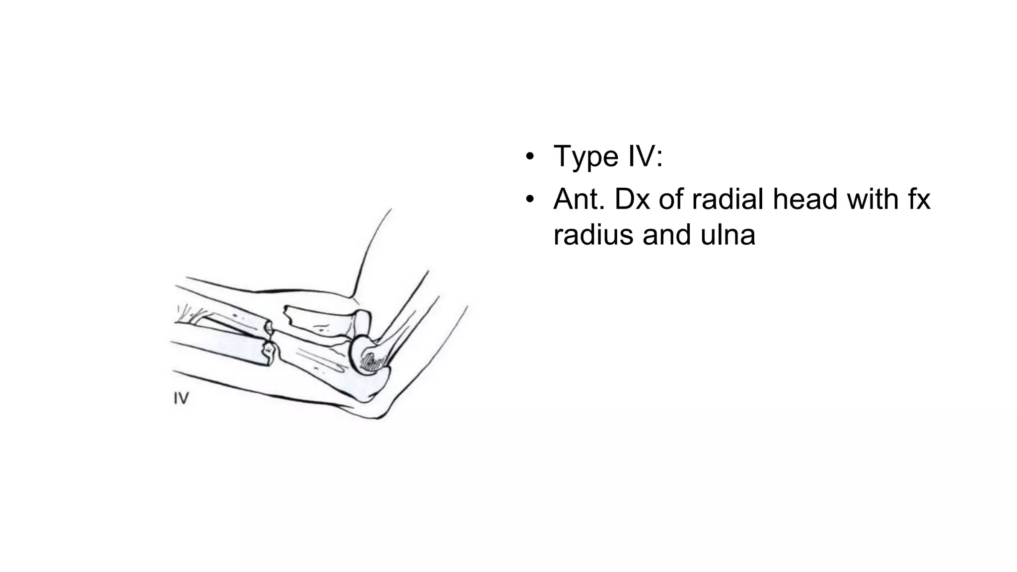Radius and ulnar shaft fx | PPTX