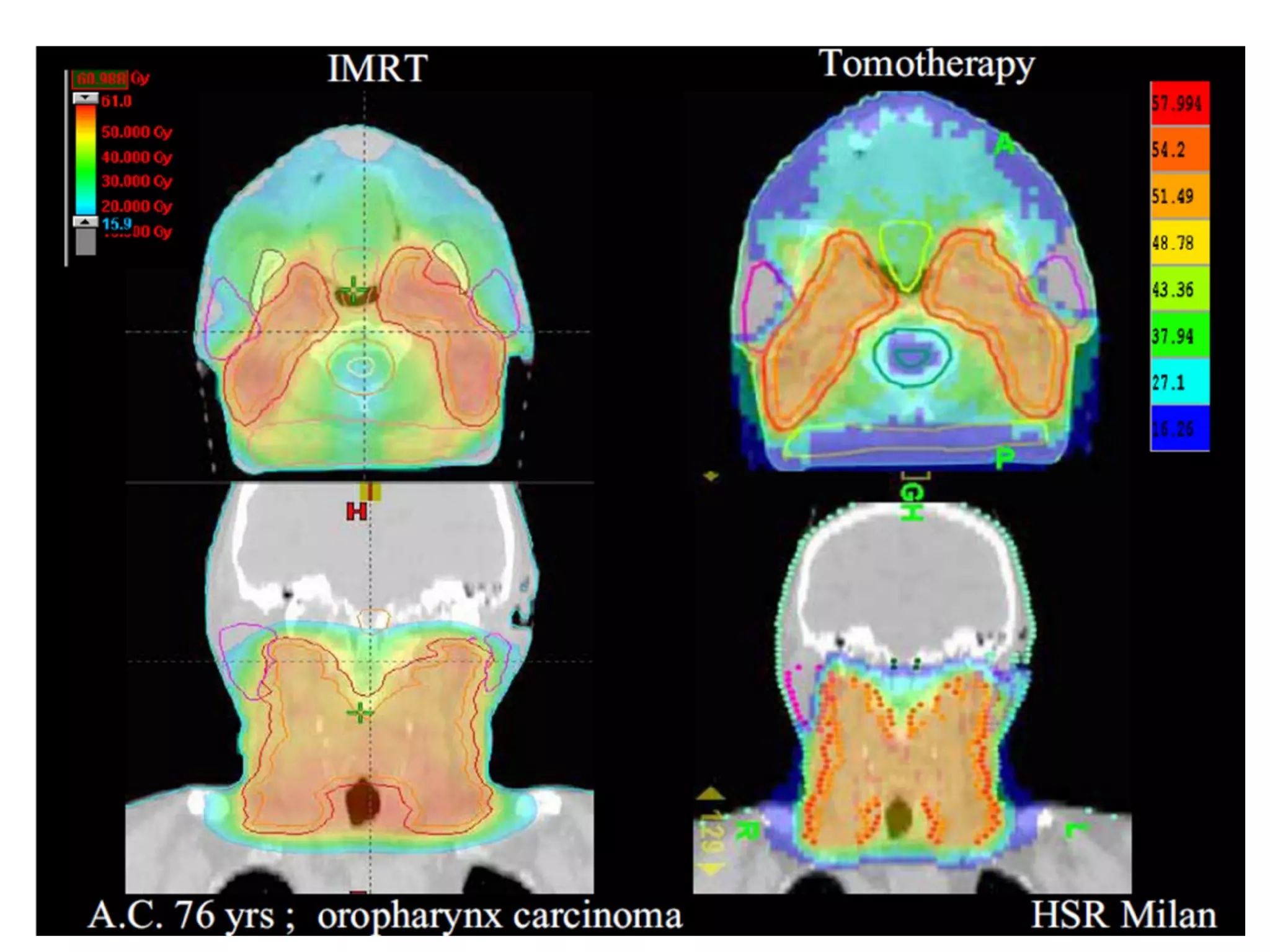 RADIXACT X9 TOMOTHERAPY SYSTEM OVERVIEW | PPT