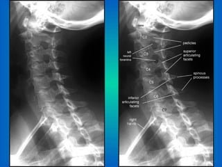 Radyolojik anatomi vertebra | PPT