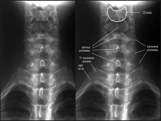 Radyolojik anatomi vertebra | PPT