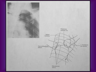 Radyolojik pozisyonlar toraks | PPT