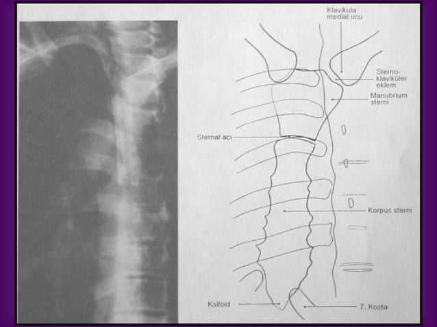 Radyolojik pozisyonlar toraks | PPT