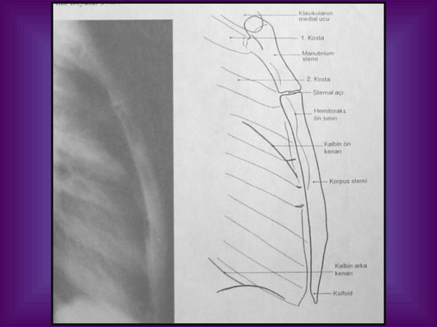 Radyolojik pozisyonlar toraks | PPT