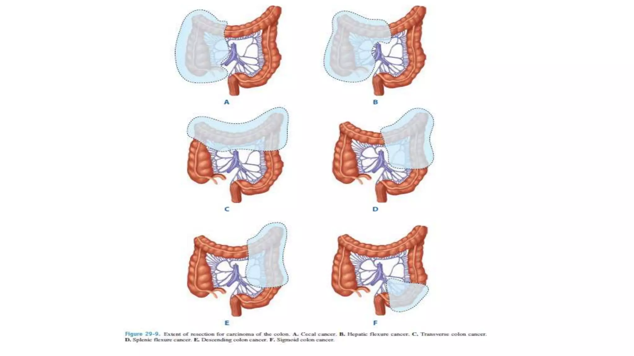 Rafdhi - Colon, Rectum, & Anus.pptx