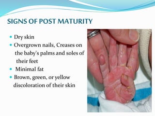 Post mature labor | PPTX