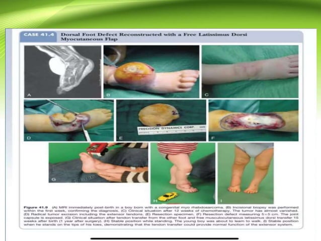 raghvendra LD flap ppt.pptx conventional workhorse flap | PPTX | Death ...