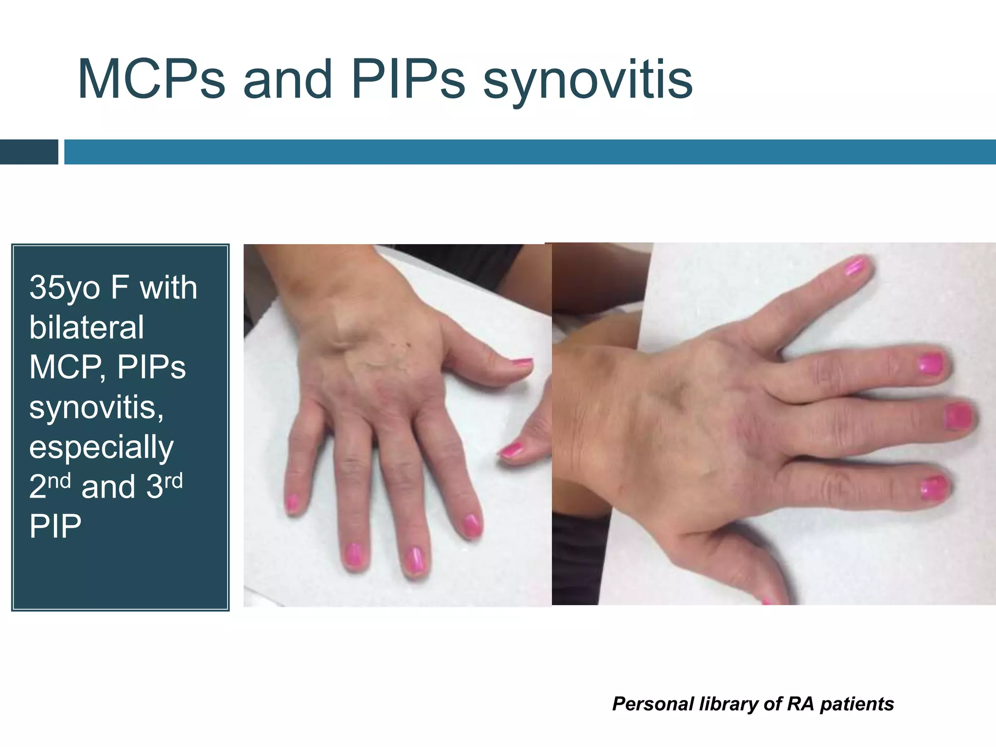 Rheumatoid arthritis | PPTX