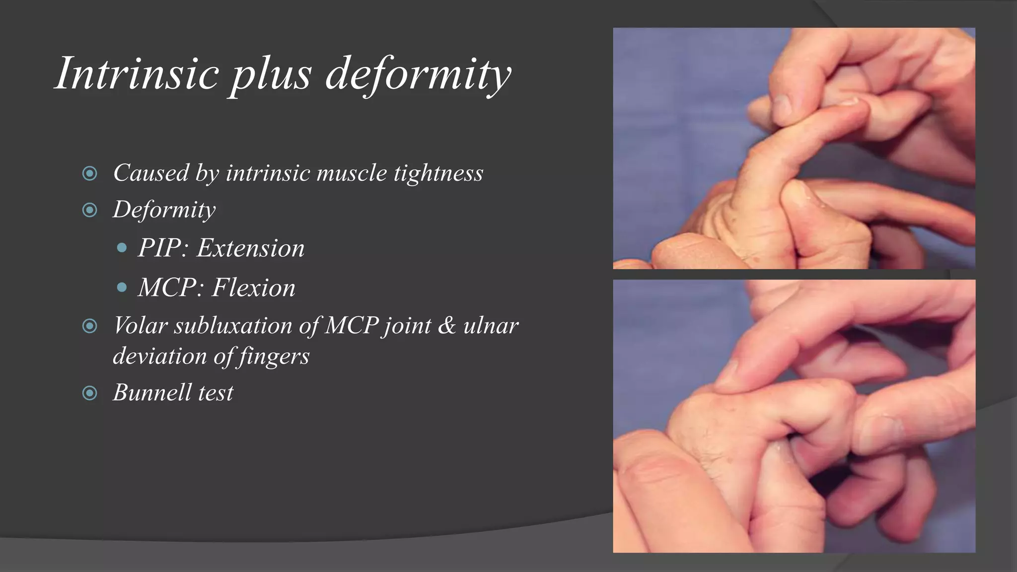 Rheumatoid Hand - Orthopaedics | PPTX