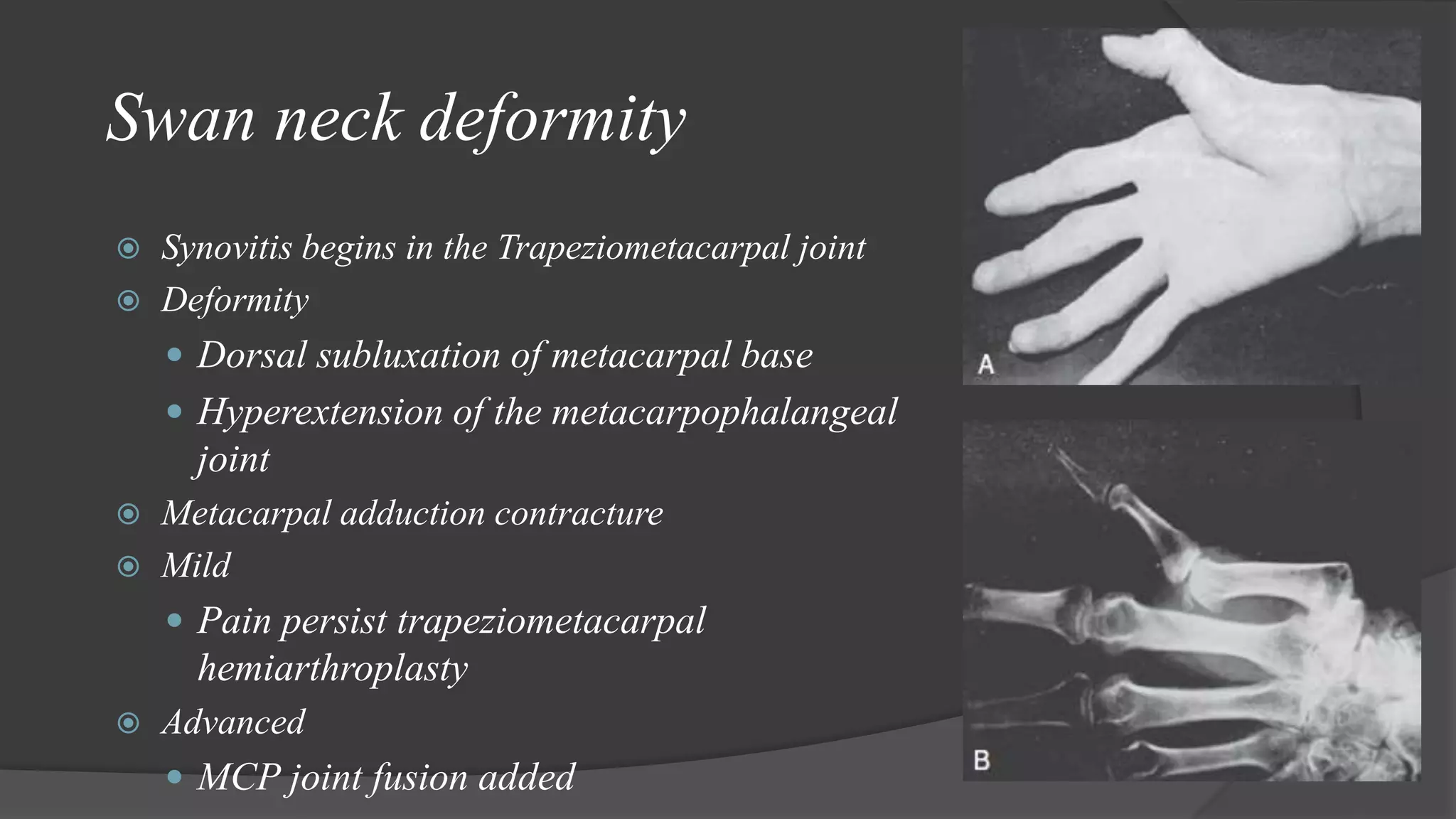 Rheumatoid Hand - Orthopaedics | PPTX
