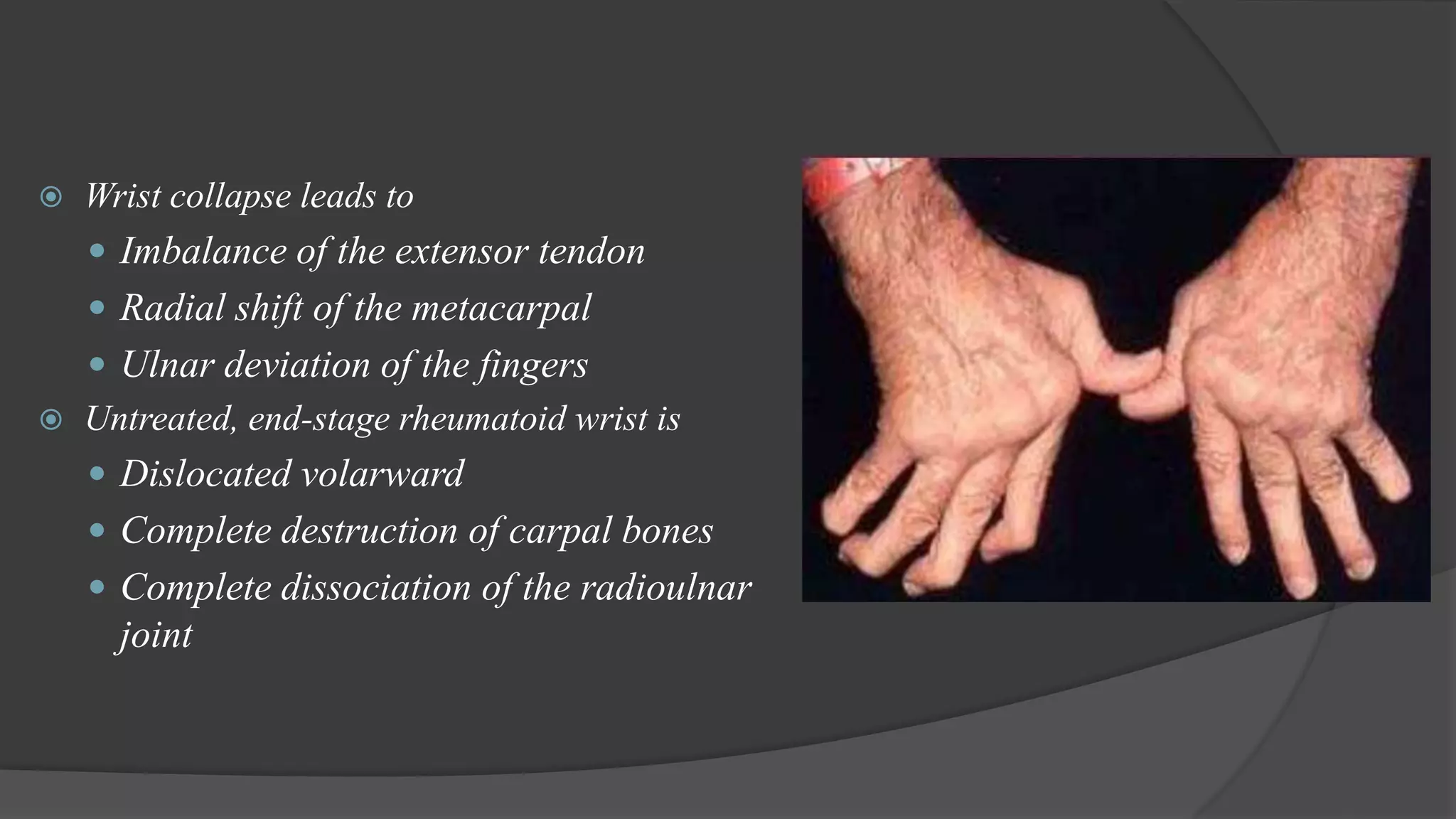 Rheumatoid Hand - Orthopaedics | PPTX