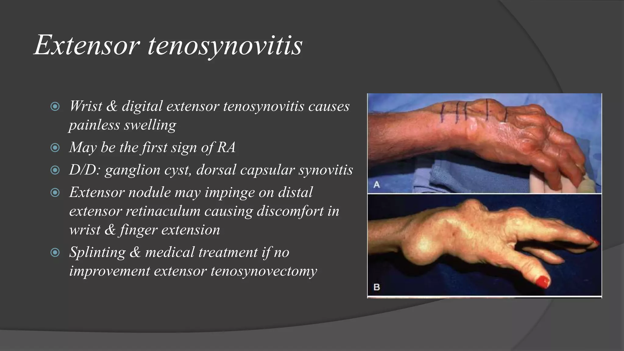 Rheumatoid Hand - Orthopaedics | PPTX