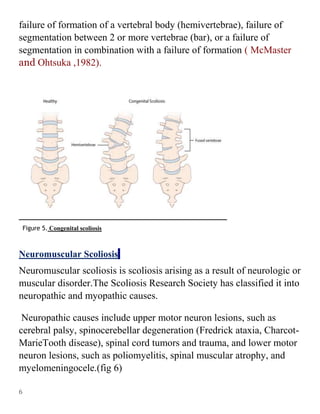 SCOLIOSIS - Presentation on SCOLIOSIS .doc | Physical Therapy | Wellness