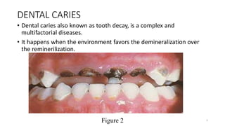 RAHMAH AHMAD SIWES PRESENTATIONON CARIES.pptx