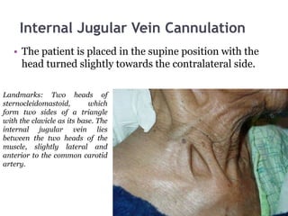 External Jugular Vein Cannulation
