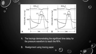 hemodynamic in cath lab: aortic stenosis and hocm | PPTX