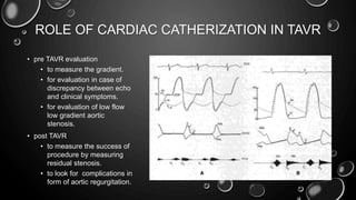 hemodynamic in cath lab: aortic stenosis and hocm | PPTX