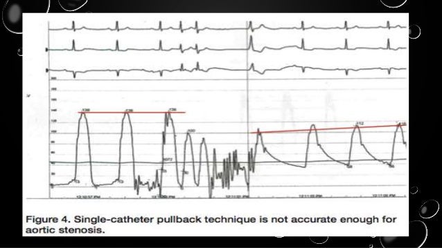 hemodynamic in cath lab: aortic stenosis and hocm