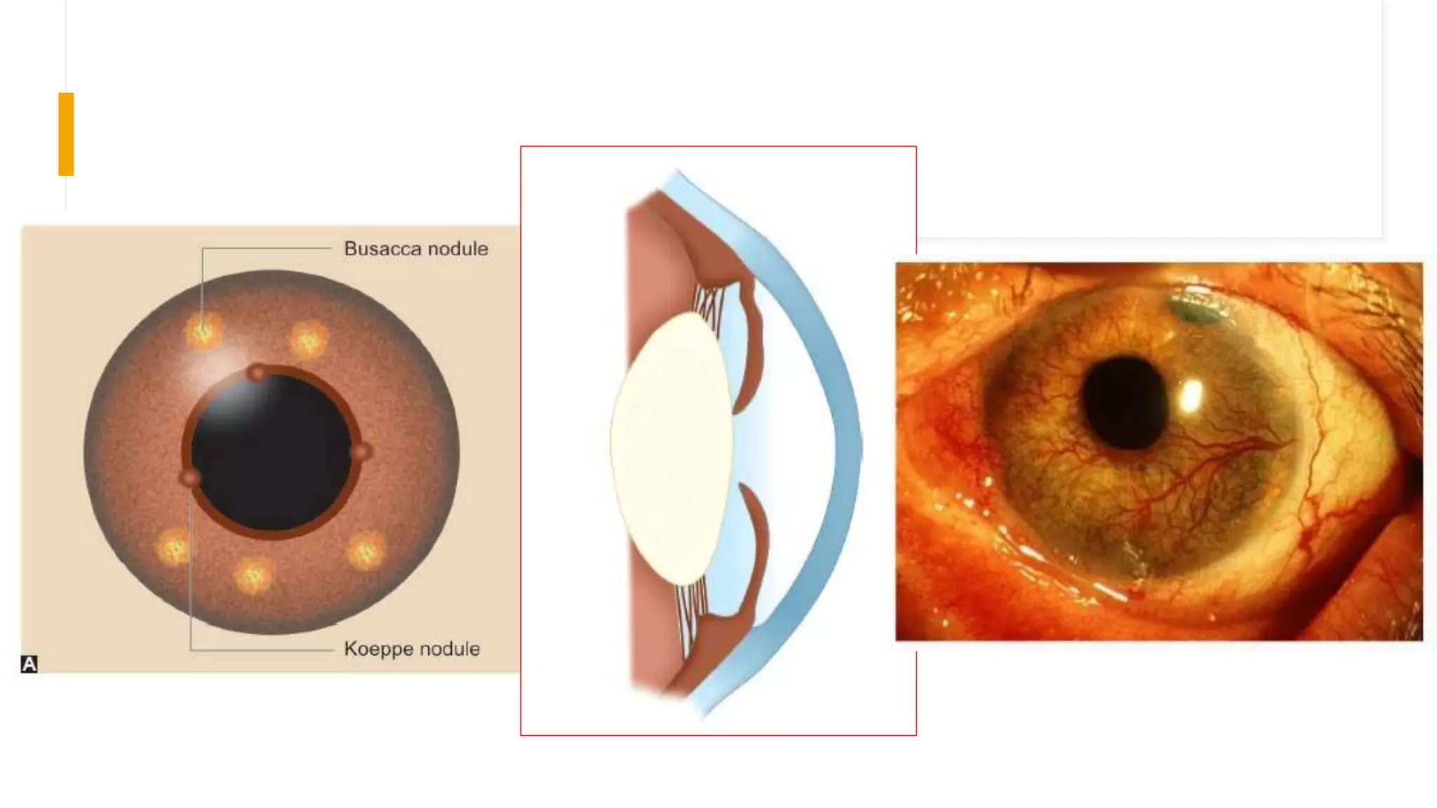 Uveitis Clinical features | PPTX