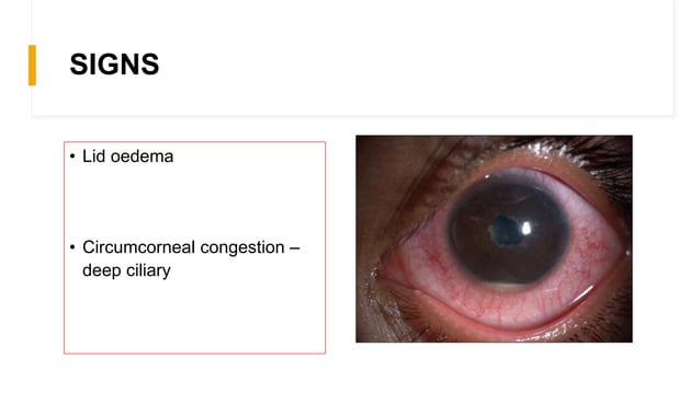 Uveitis Clinical features | PPT