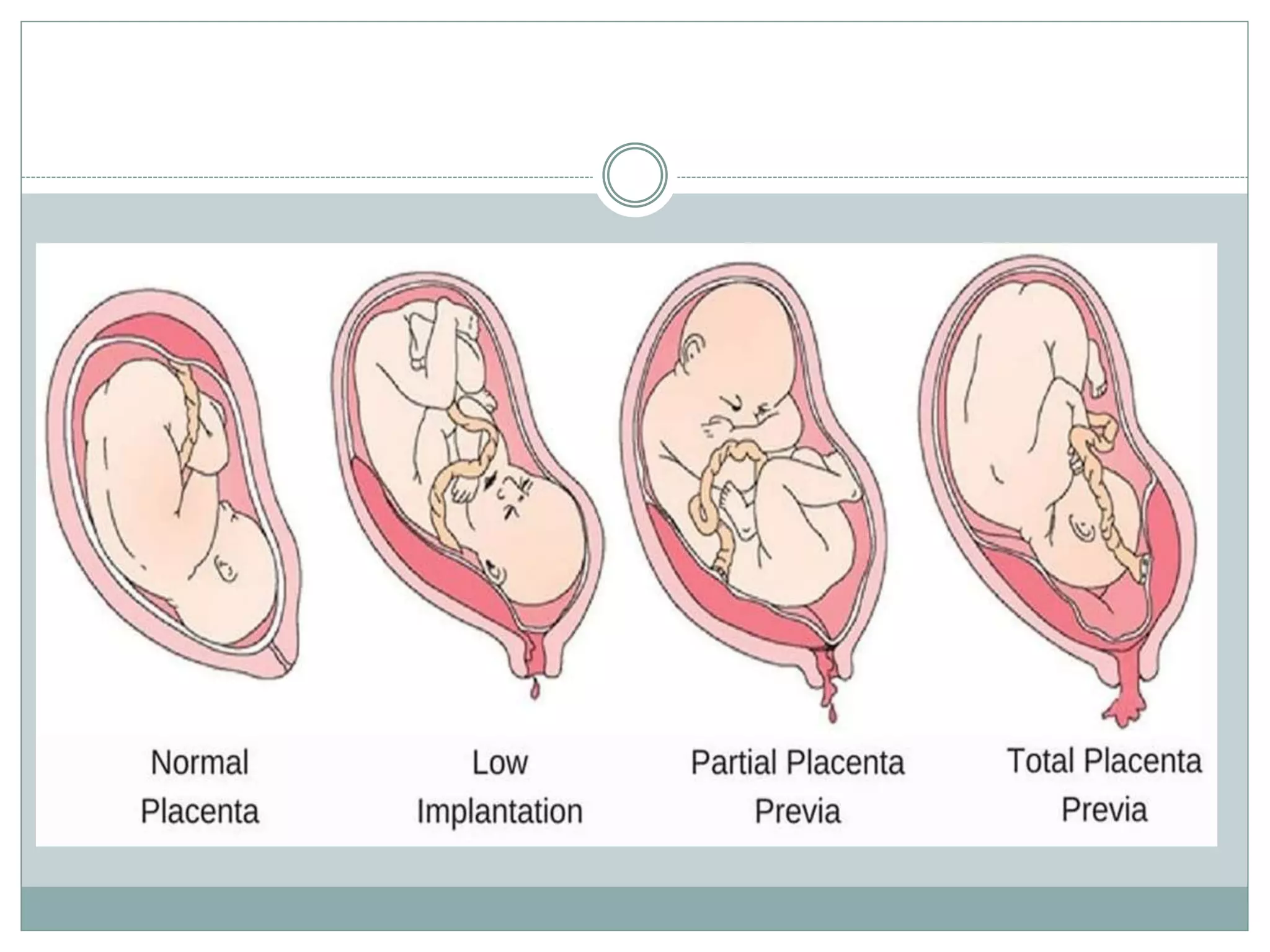 obstetric emergency | PPTX
