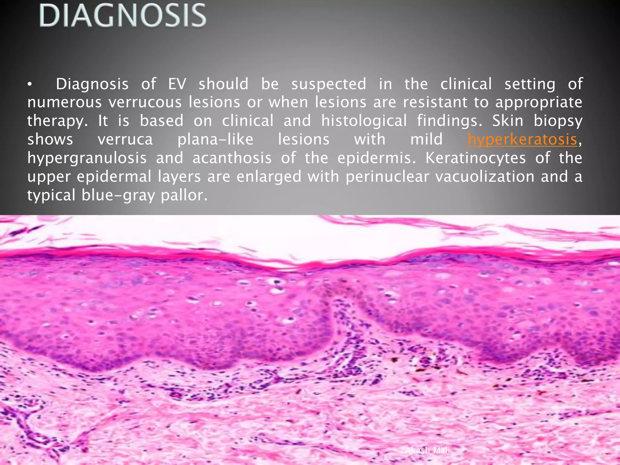 Mutation Gene Disorders Epidermodysplasia verruciformis | PPTX