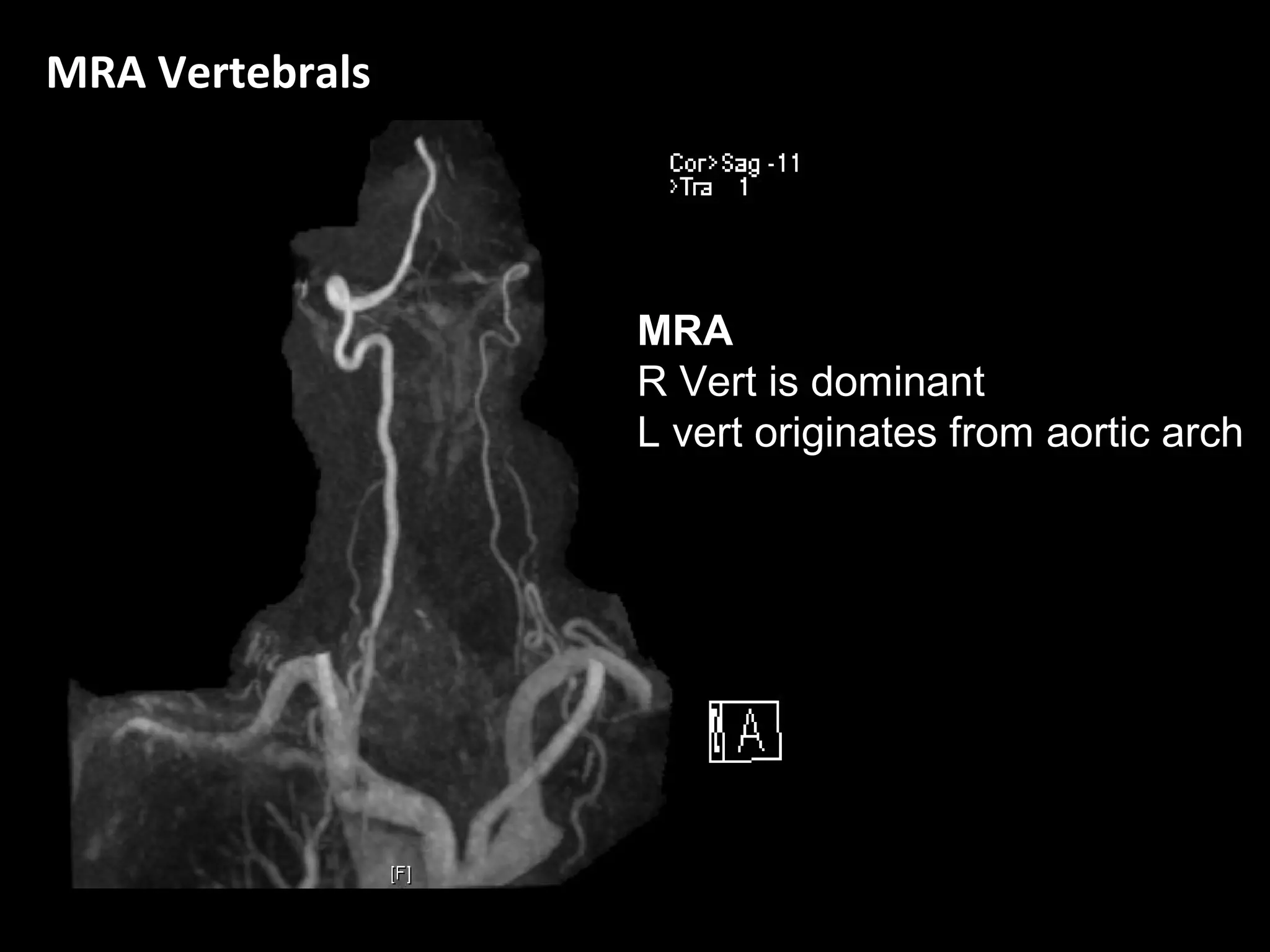 Right AICA PICA stroke | PPT