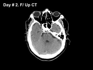 Right AICA PICA stroke | PPT