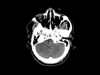 Right AICA PICA stroke | PPT